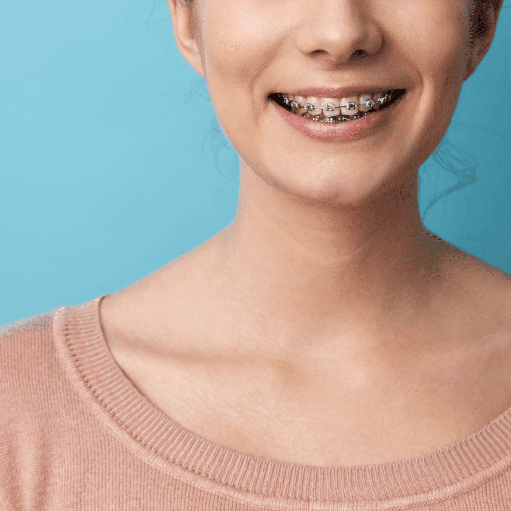 3 Things You Should Know About Getting Braces Off | Dunegan & Cole ...
